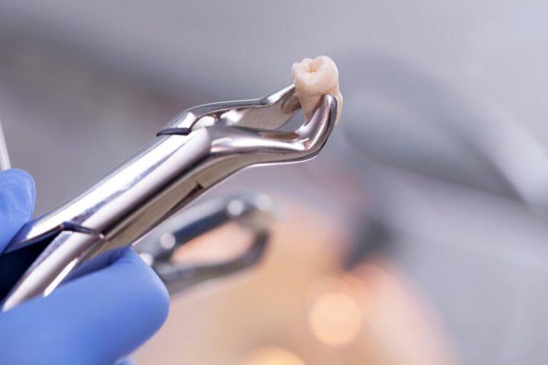 4 Tips to Avoid Dry Socket After a Tooth Extraction - Kemper Meadow ...